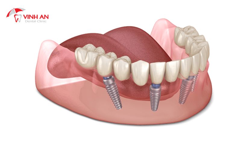Phương Pháp Phục Hình Implant Toàn Hàm All On 4 Và All On 6