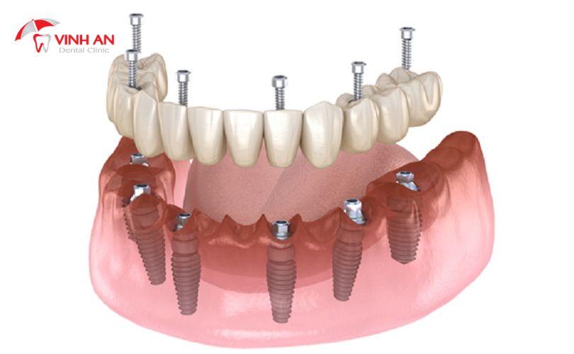 Phương Pháp Phục Hình Implant Toàn Hàm All On 4 Và All On 6