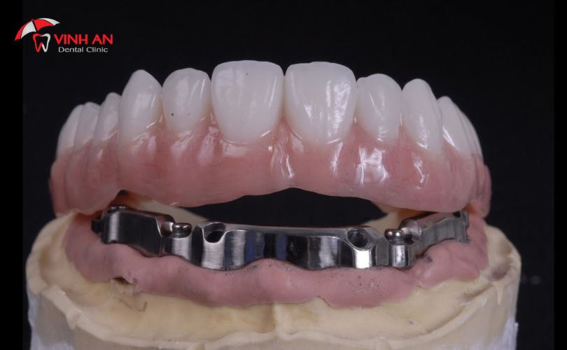 Phương Pháp Phục Hình Implant Toàn Hàm All On 4 Và All On 6