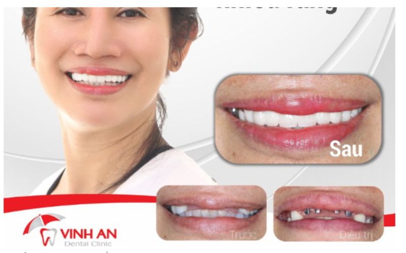 Phương Pháp Phục Hình Implant Toàn Hàm All On 4 Và All On 6