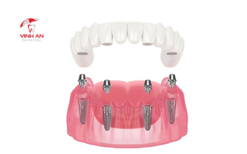 Phương Pháp Phục Hình Implant Toàn Hàm All On 4 Và All On 6
