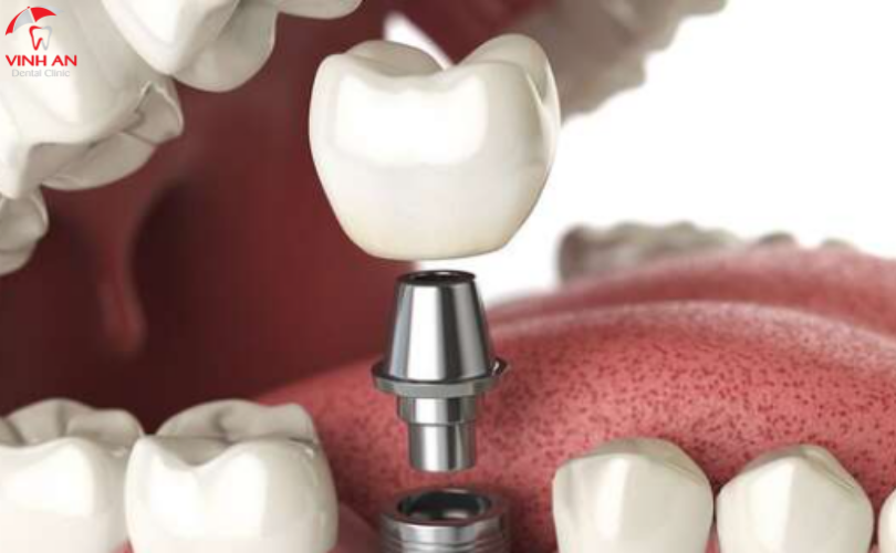 Trụ Implant Sic Có Cấu Tạo và Xuất Xứ Từ Đâu? Ưu Điểm Và Gía Cả